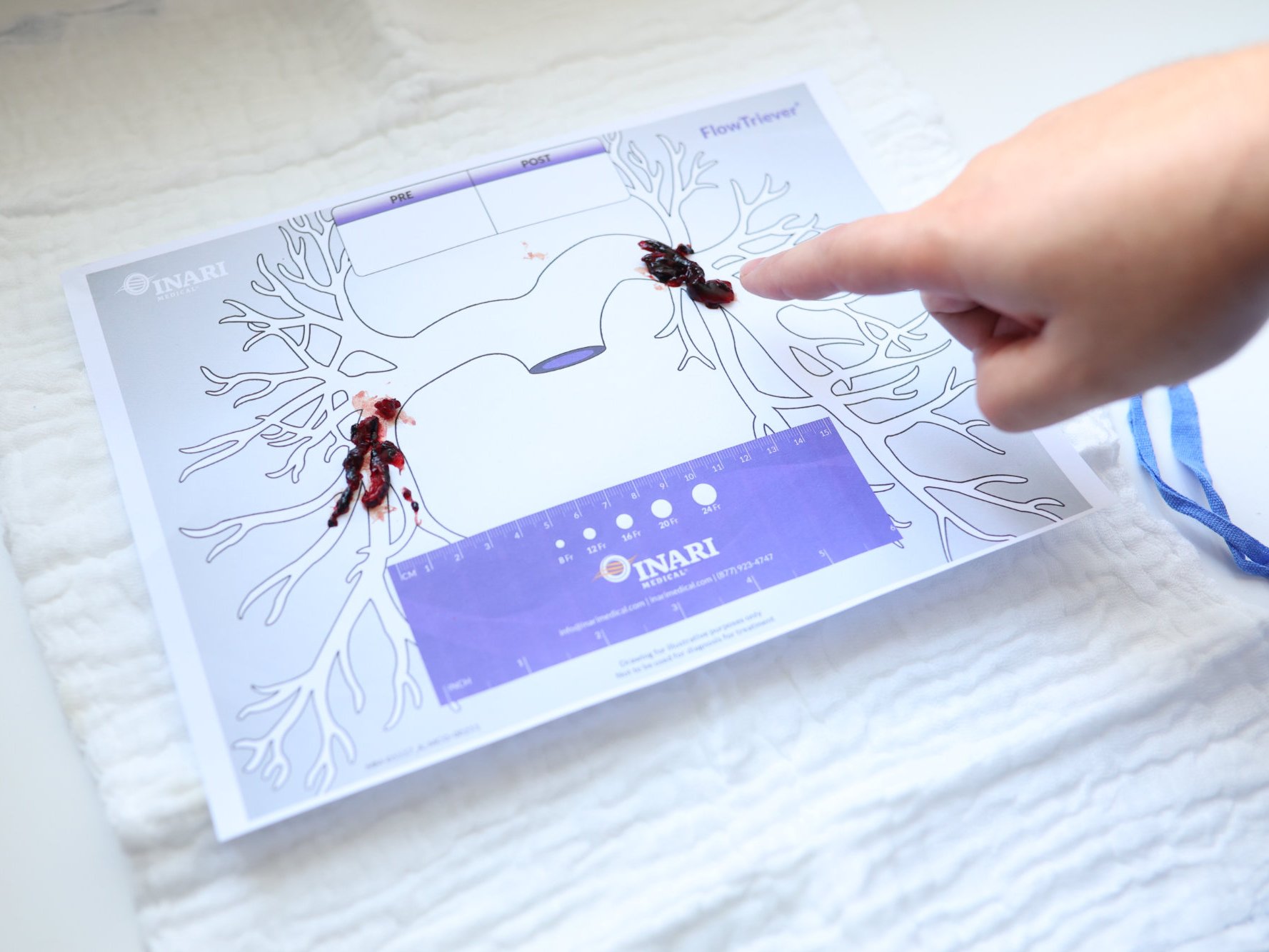 Lebensgefahr Lungenembolie – wie ein neuartiger Arterien-Staubsauger in ...